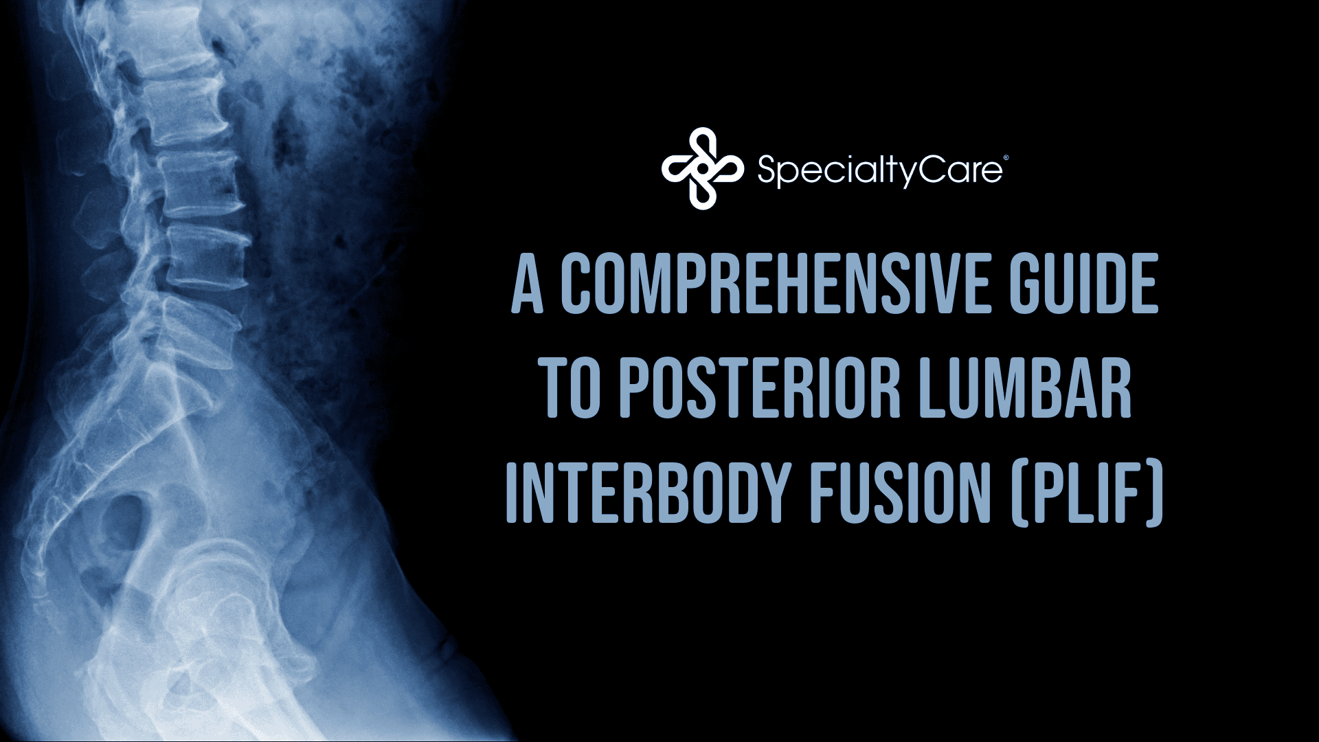 A Comprehensive Guide to Posterior Lumbar Interbody Fusion (PLIF ...
